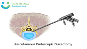 Percutaneous Endoscopic Discectomy Explained: A Patient's Guide
